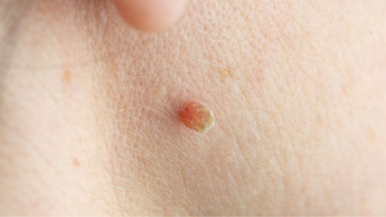 What Causes Skin Tags? - Linia Skin Clinic
