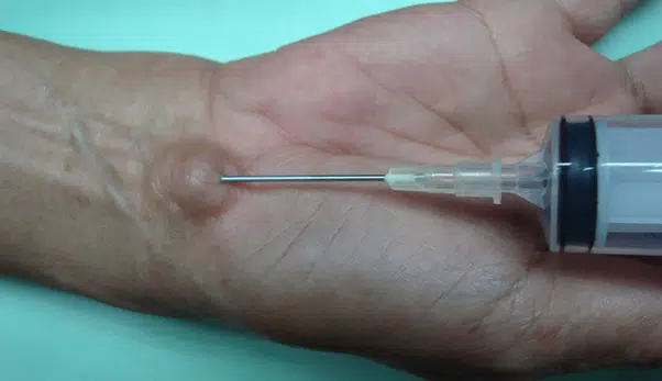 How to Remove a Cyst: Treatment, Removal & Prevention - Linia Skin Clinic