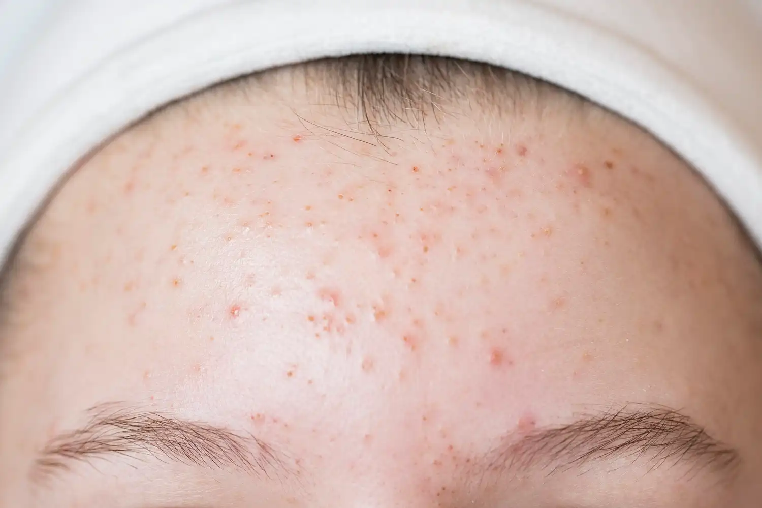 Forehead Acne: Causes & Treatments - Linia Skin Clinic