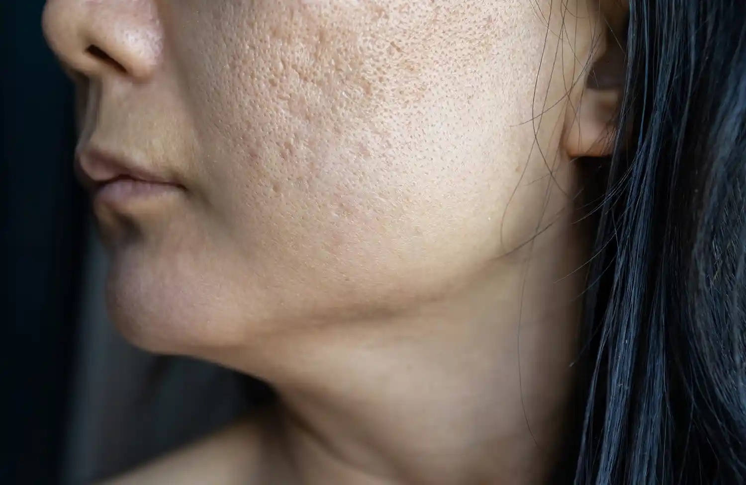 Ice Pick Acne Scars: Causes, Types, and Treatments