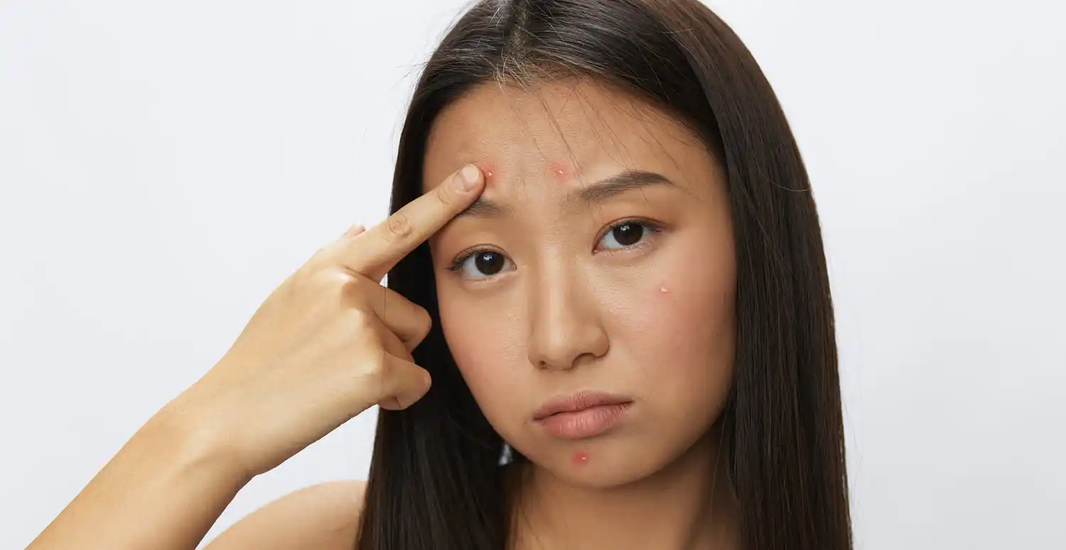 Cyst Removal from Forehead: Your Complete Guide